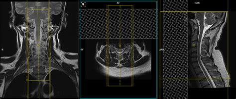 Mri Csf Leak Cervical Spine Mri Csf Leak Protocol And Planning