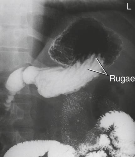 Radt 1220 Chapter 12 Biliary Tract And Upper Gastrointestinal System