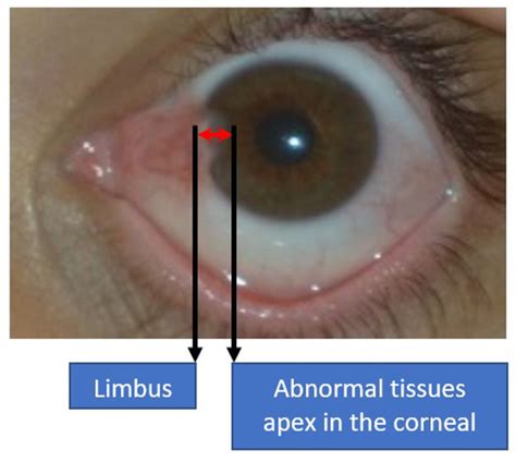 Diagnostics Special Issue Artificial Intelligence In Eye Disease