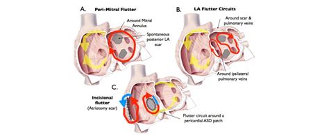 Atrial Flutter Ablation One Heart Cardiology