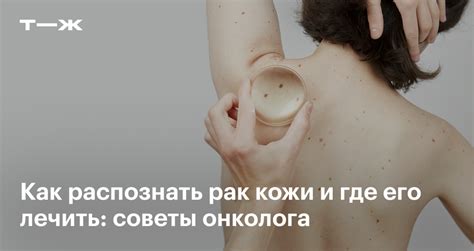 Как выглядит рак кожи и как его лечат