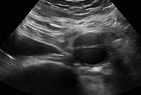 Abdomen And Retroperitoneum 19 Retroperitoneum And Great Vessels