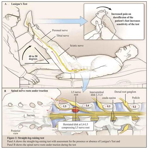 Crossed Straight Leg Raise Test