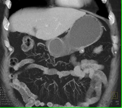 1cm Gastric Gist Tumor With Calcification Stomach Radiology Case