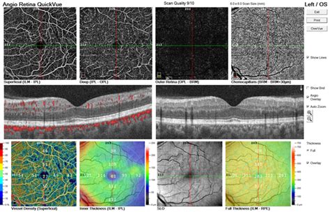 Paracentral Acute Middle Maculopathy Associated With Non Arteritic