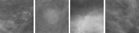 figure 2 from detection of microcalcifications in mammograms based on