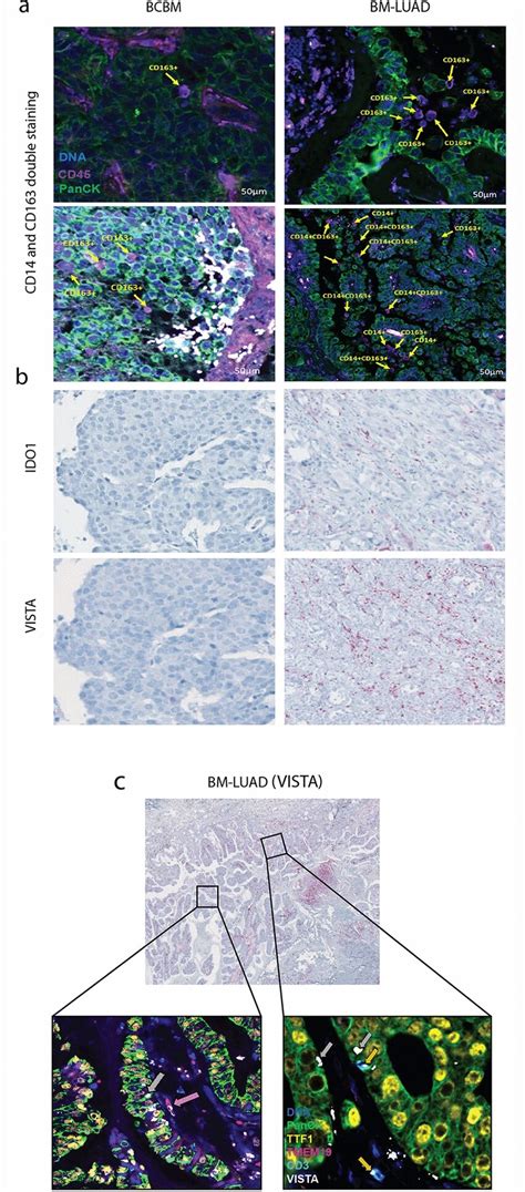 Digital Spatial Profiling Of Bm Luad And Bcbm A Ihc Double Staining By
