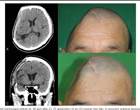 Life After Craniotomy What To Expect After A Craniotomy A Guide To
