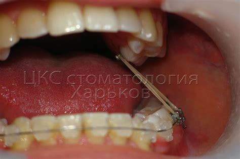 О стоматологии и не только...: Ортодонтические эластики. Эластики для ...