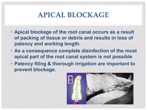 Endodontic Errors Pptx