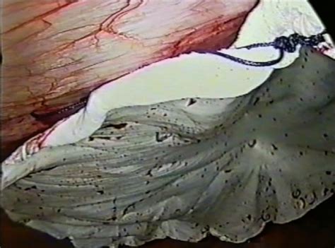 Laparoscopic Repair Of Ventral Incisional Hernias Pmc