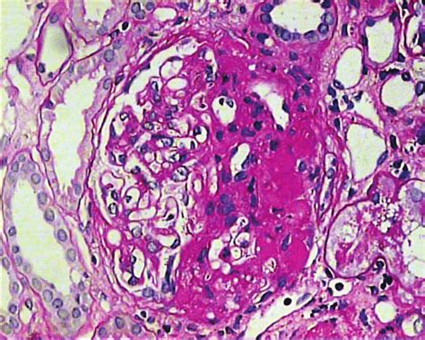 Glomerulus Showing Segmental Sclerosis Hyalinosis Involving Almost Half Download Scientific