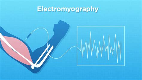 هزینه نوار عصب و عضله با بیمه تکمیلی تهران سال 1402چقدر است؟
