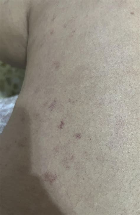Help I Dont Know Whats Causing It R Dermatologyquestions