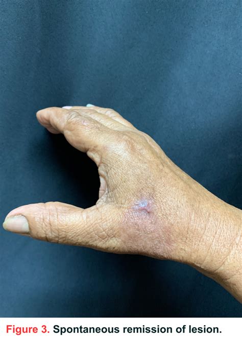 Pathergy Phenomenom Indicator Of Recurrent Vegetative Pyoderma Gangrenosum
