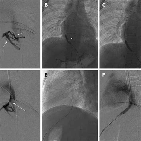 Hepatic Venogram After Percutaneous Puncture A Occlusion Of Hepatic