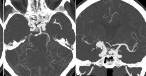Aneurysm Of Persistent Trigeminal Artery