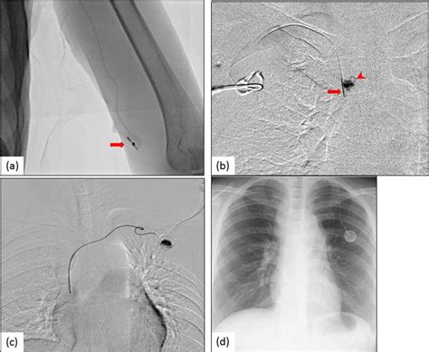 Abnormal Flow Confirmation Study Of Central Venous Ports CVPs A A Download Scientific