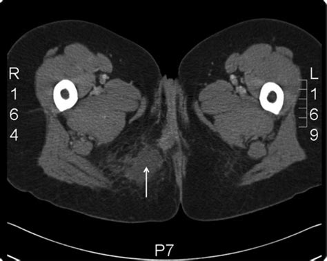 Ischiorectal Fossa Abscess After Pelvic Floor Injection Of Botulinum Toxin Obgyn Key