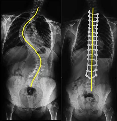 Some Details Of Scoliosis Surgery • Assoc Prof Dr Mehmet Nuri Erdem