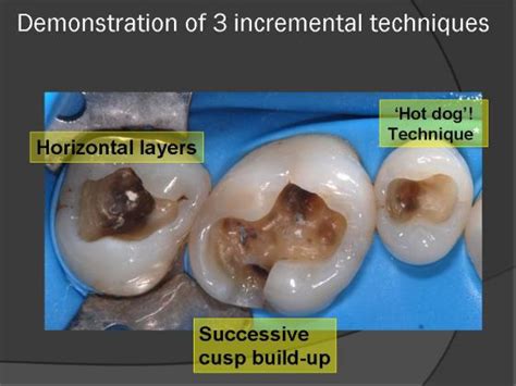 Direct Restorations Posterior Composite Three Techniques For Incremental Placement Of Composite