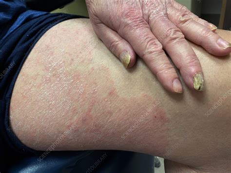 Ringworm Stock Image C057 2372 Science Photo Library
