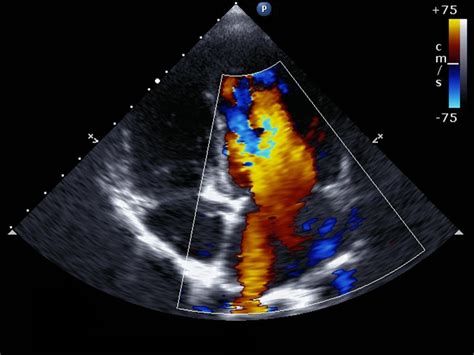 Echocardiogram Purpose Types And Risks