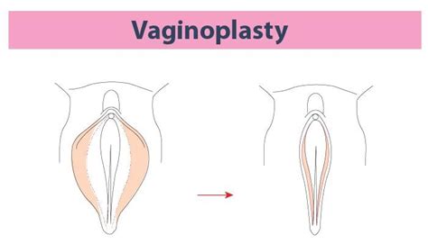 Recovery After Vaginoplasty Risk Factors And Precautions