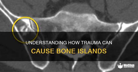 Understanding How Trauma Can Cause Bone Islands MedShun