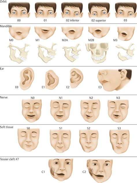 4 Craniofacial Microsomia Plastic Surgery Key