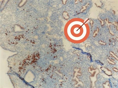 Plasmocytes Doing Fiesta Time Within The Endometrial Mucosa Ioana