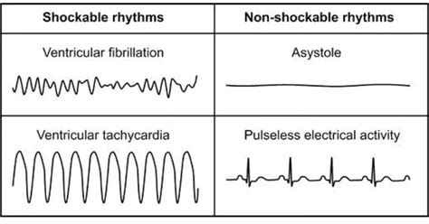 Understanding Shockable Vs Non Shockable Heart Rhythms