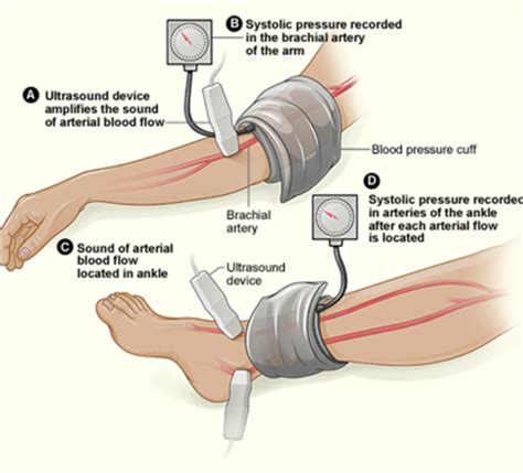 Y3 Surgery B Abpi Flashcards Quizlet