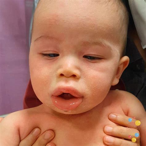 Anaphylaxis Skin Deep
