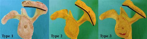 Acromial Morphology Type I Flat Inferior Surface Type Ii Curved Download Scientific Diagram
