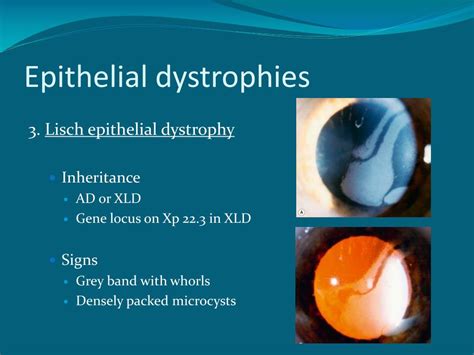 Ppt Corneal Dystrophies Powerpoint Presentation Free Download Id