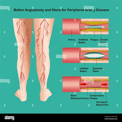Diagram Showing Angioplasty For Peripheral Artery Disease Illustration Concept Of Dry Skin Old
