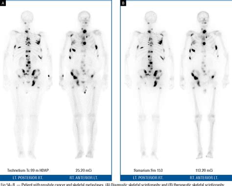 Bone Scan In Prostate Cancer
