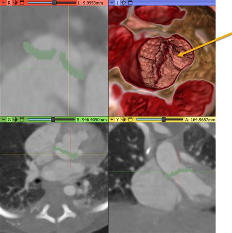 New Feature Soft Edge Option In Volume Masking Support 3d Slicer Community
