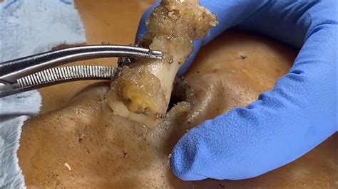 [asmr] Huge Blackhead Most Satisfying Removal Skincare Transformation