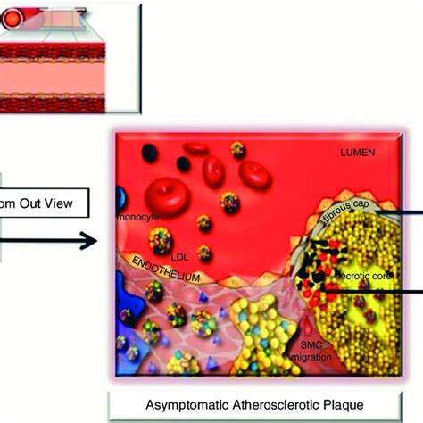 Thin Capped Fibroatheroma Download Scientific Diagram