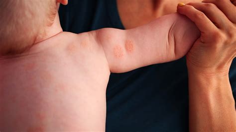 Nummular Eczema Types Of Eczema Gladskin