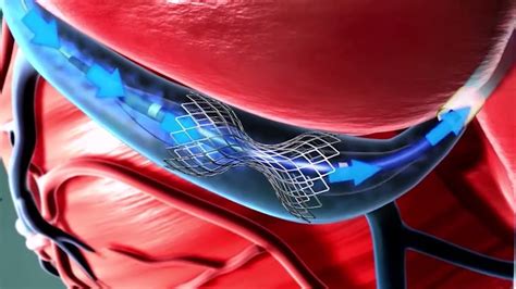 Shockwave Reducer Shockwave Medical