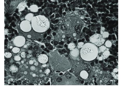 Lymph Node With Multinucleated Giant Cells Vacuoles And Refractive
