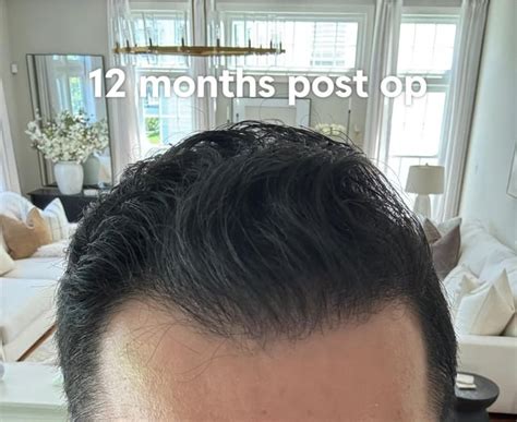 Frontal Hair Transplant Dr Ibrahim Jebai Beirut R Hairtransplants