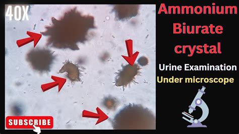 Ammonium Biurate Crystal In Urine Microscopic Examination Medicallabtechnologysajal6903