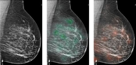 Example Heatmaps Generated By The Patch Level Model Proposed By Wu Et Download Scientific