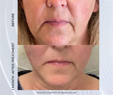 Pdo Threads In Connecticut Cure Med Spa