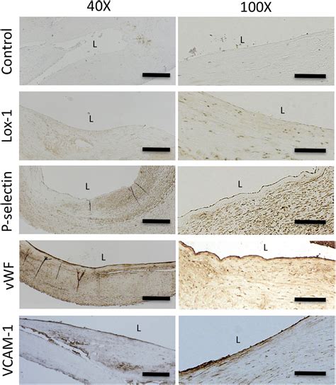 Endothelial Vascular Cell Adhesion Molecule 1 Is A Marker For High Risk Carotid Plaques And