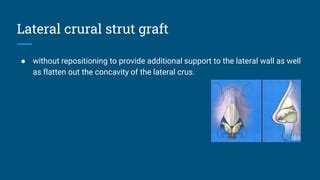 Surgical Management Of Nasal Valve Insufficiency Pptx